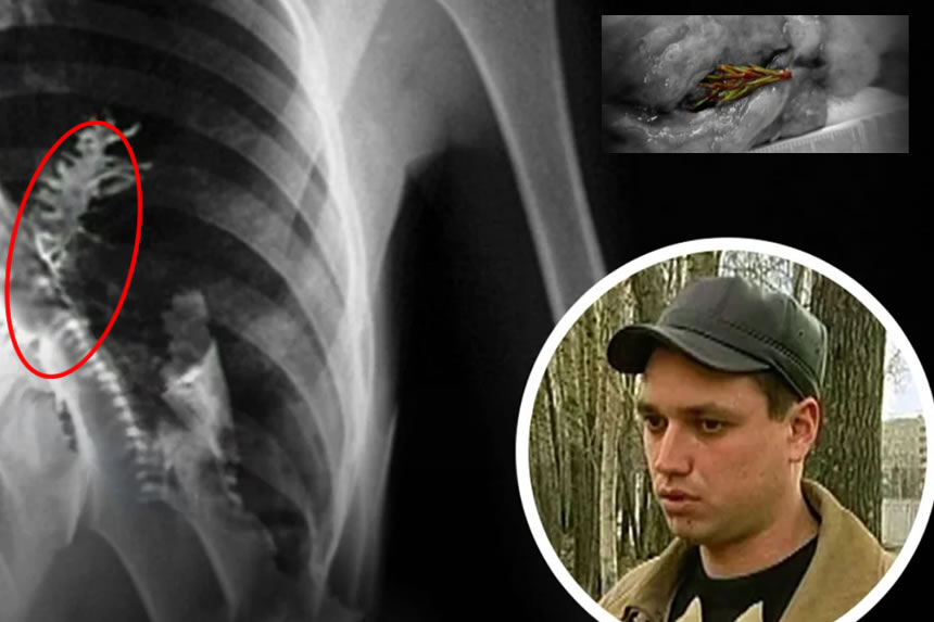 Maajabu! Mti wakutwa umeota kwenye mapafu ya binadamu - PMTV